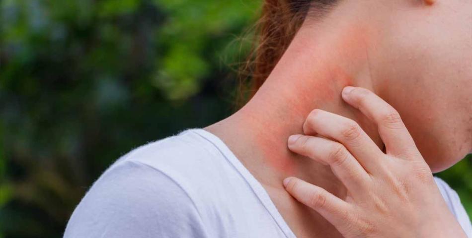 Dermatitis atópica: cómo prevenirla y tratarla | Teva